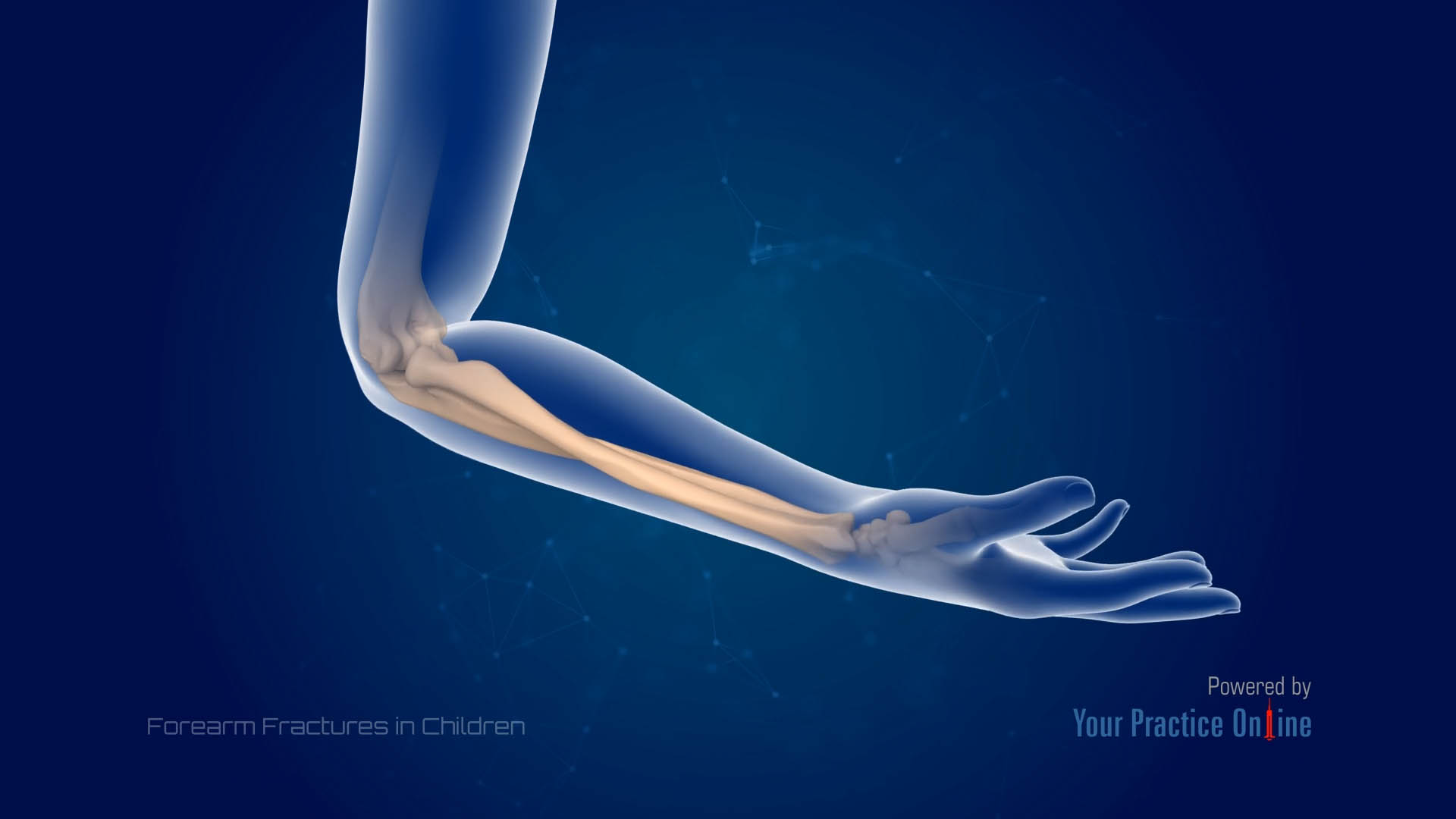 Forearm Fractures in Children Video | Medical Video Library