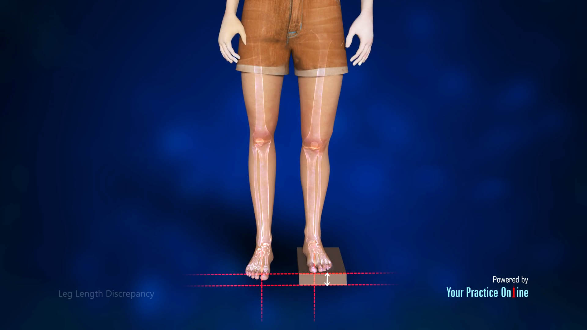 Leg Length Discrepancy (Including use of the PRECICE nail to treat ...