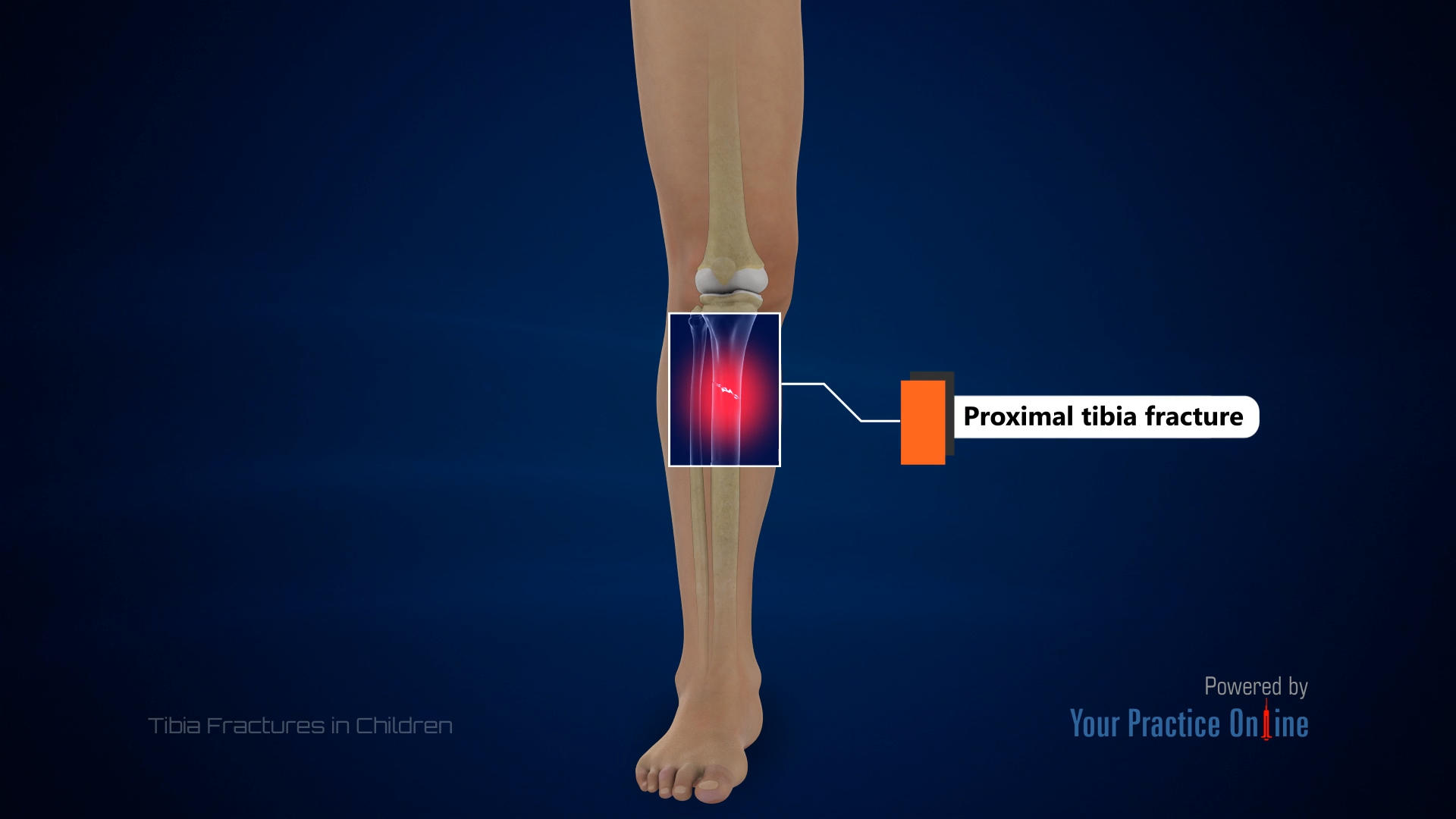 Tibia Fractures In Children Video Medical Video Library