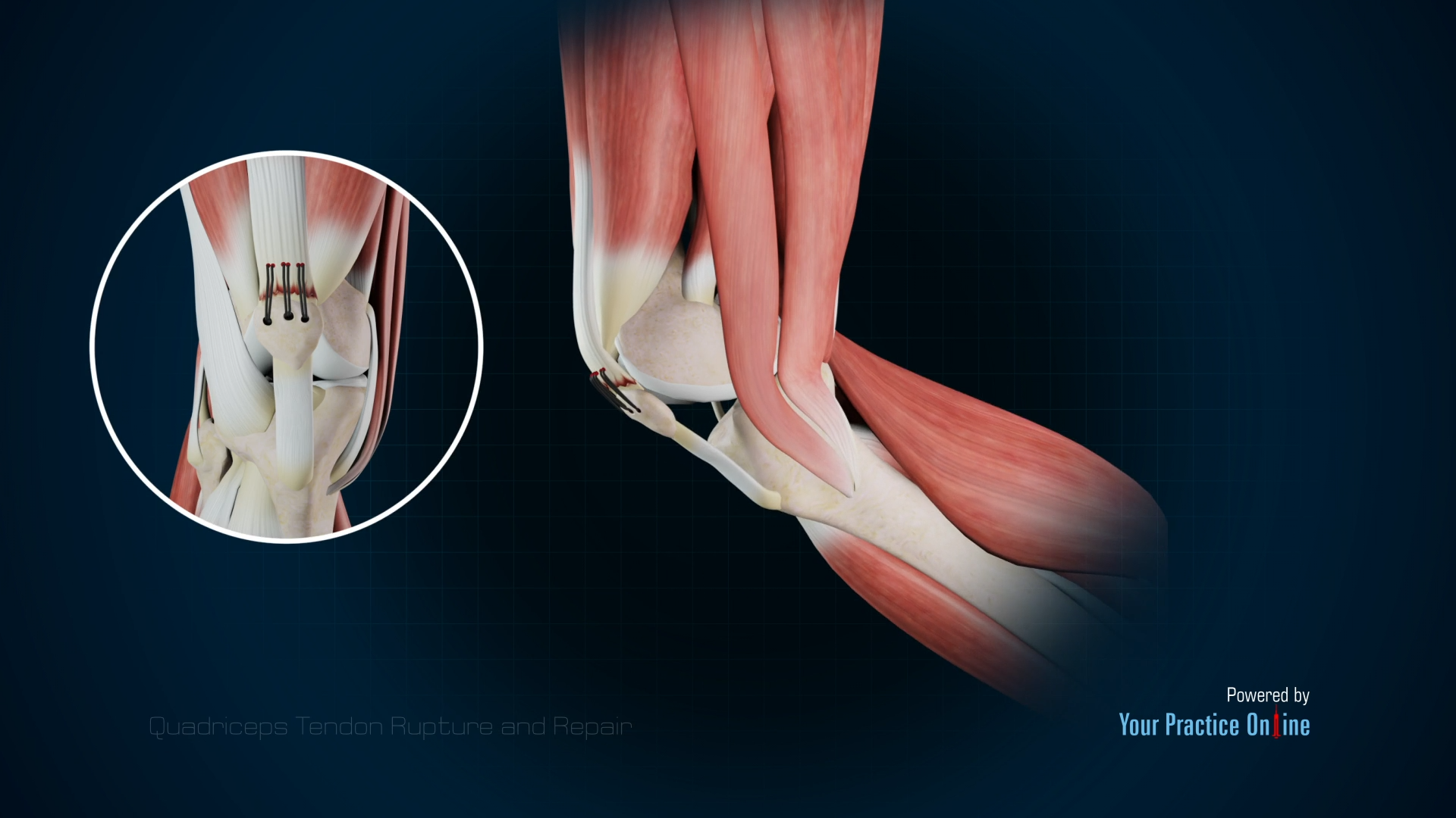 Quadriceps Tendon Rupture Quadriceps Tendon Repair 54 OFF