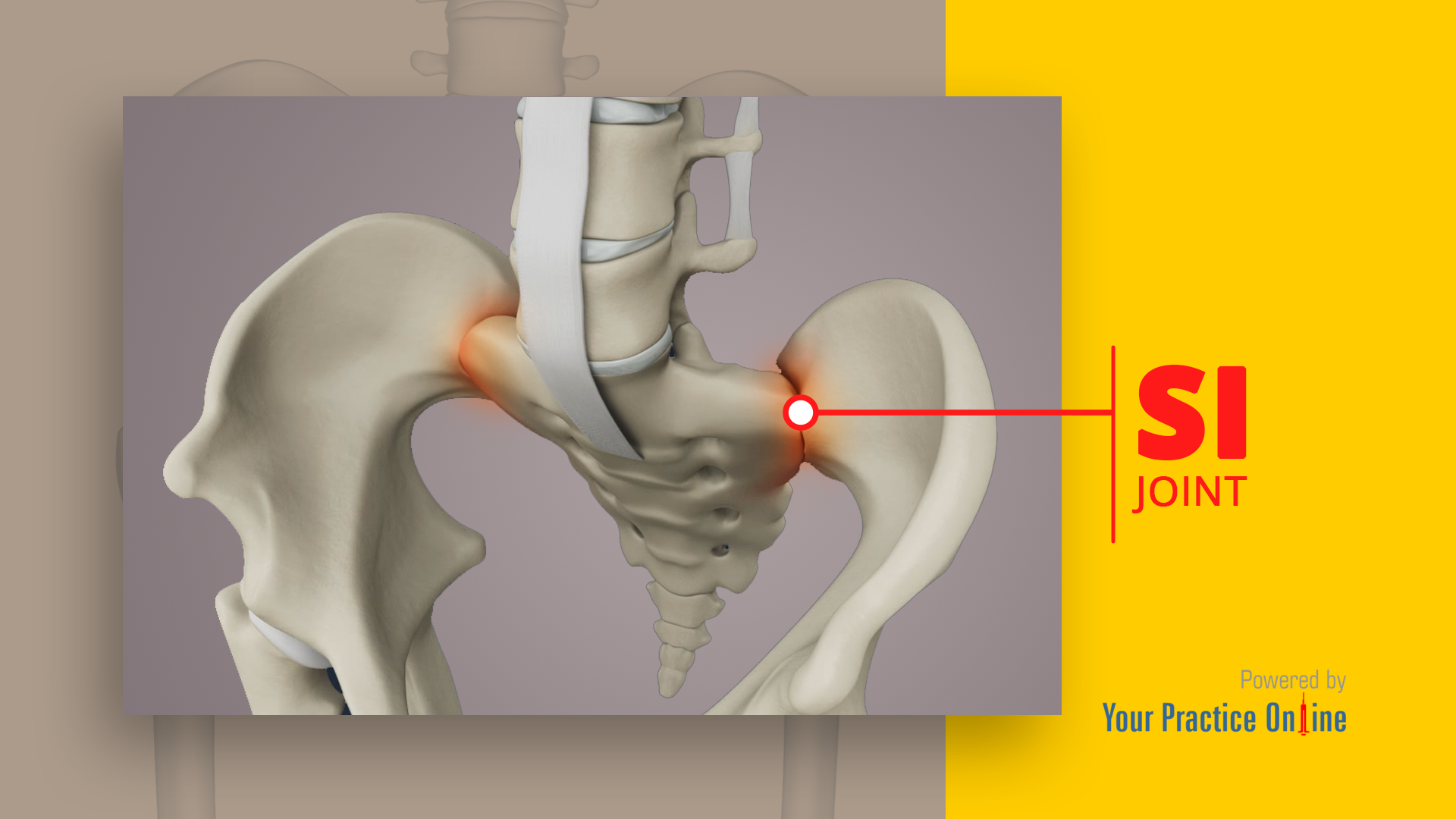 MIS SIJ Fusion Video | Medical Video Library