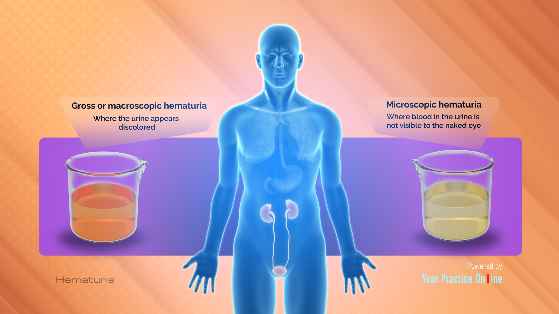 Hematuria Video | Medical Video Library