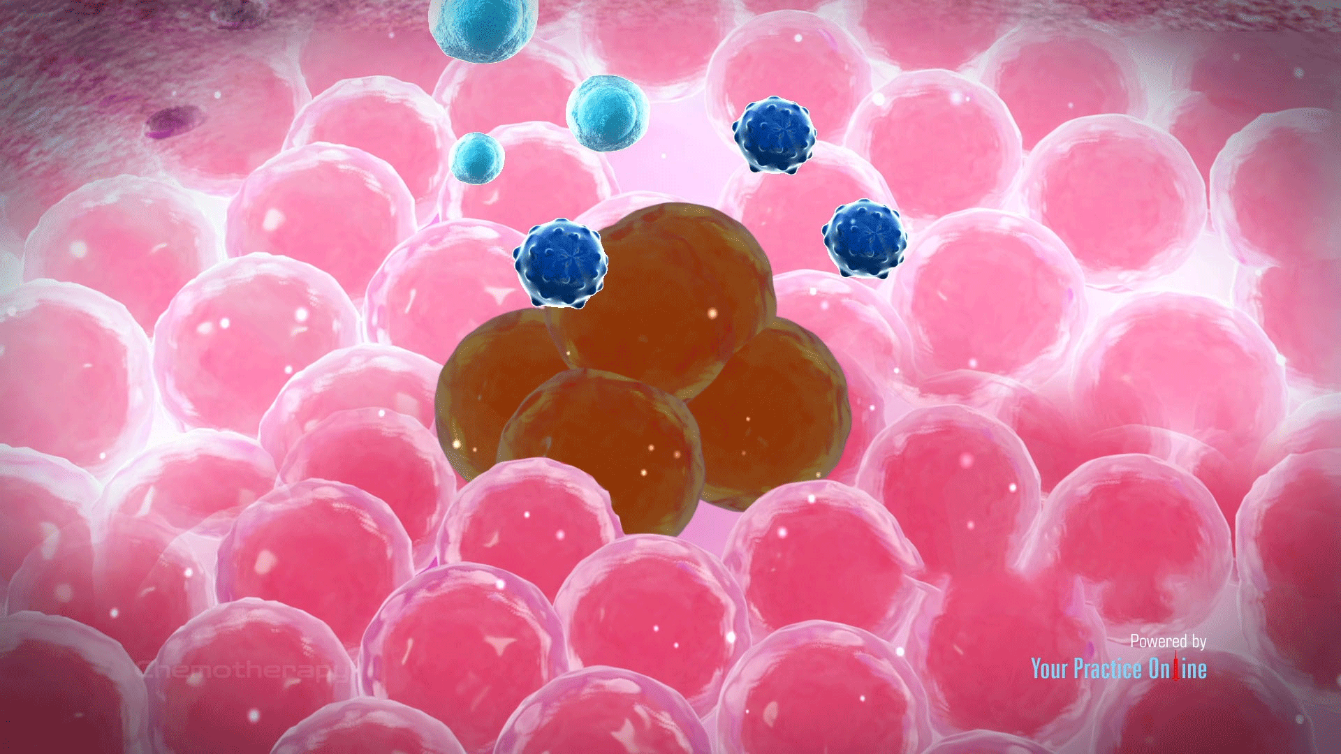Chemotherapy Video | Medical Video Library