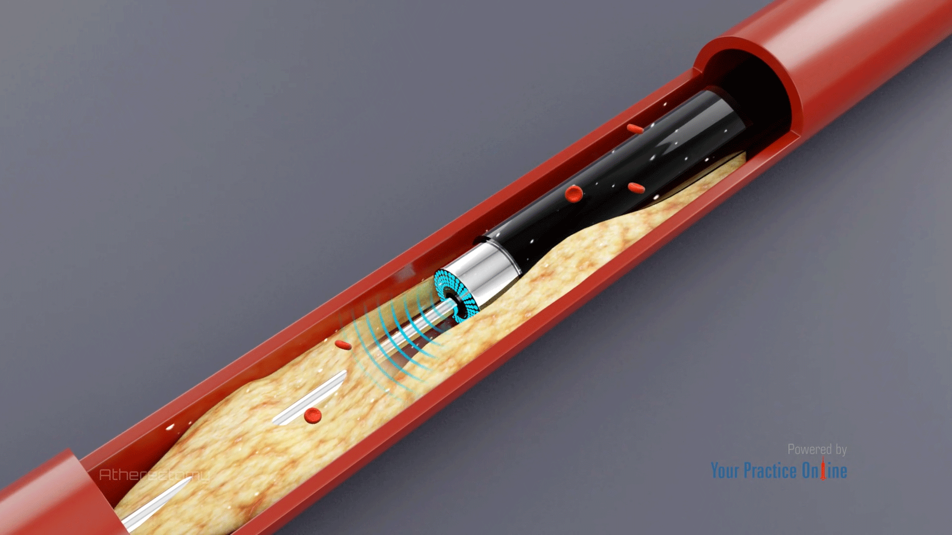 Atherectomy Video | Medical Video Library