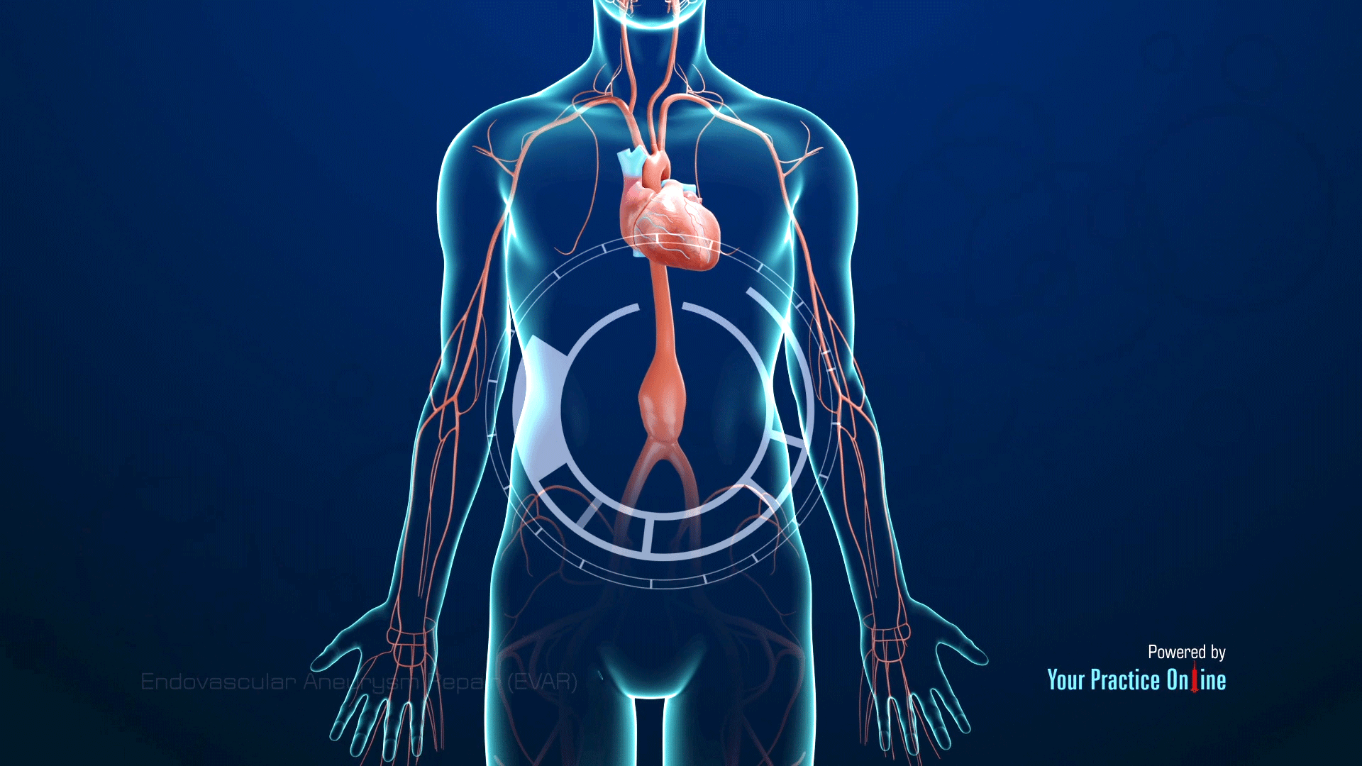Endovascular Aneurysm Repair (EVAR) Video | Medical Video Library