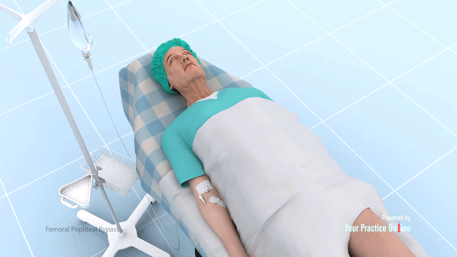 Femoral Popliteal Bypass Video | Medical Video Library