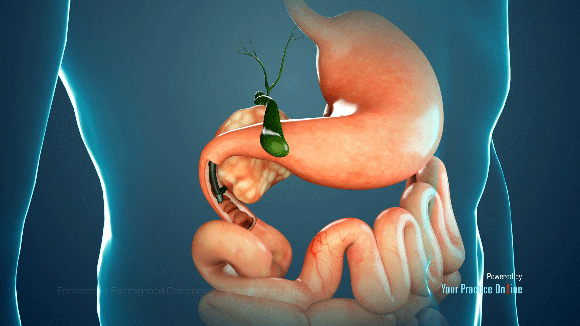 Endoscopic Retrograde Cholangiopancreatography Ercp Video Medical