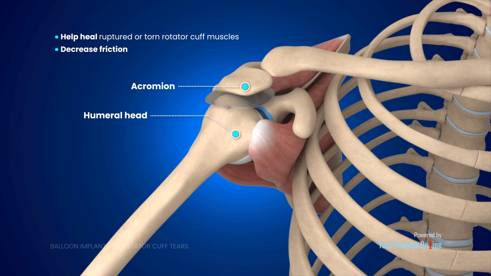 Balloon Implant For Rotator Cuff Tears Video Medical Video Library balloon-implant-for-rotator-cuff-tears-video-medical-video-library