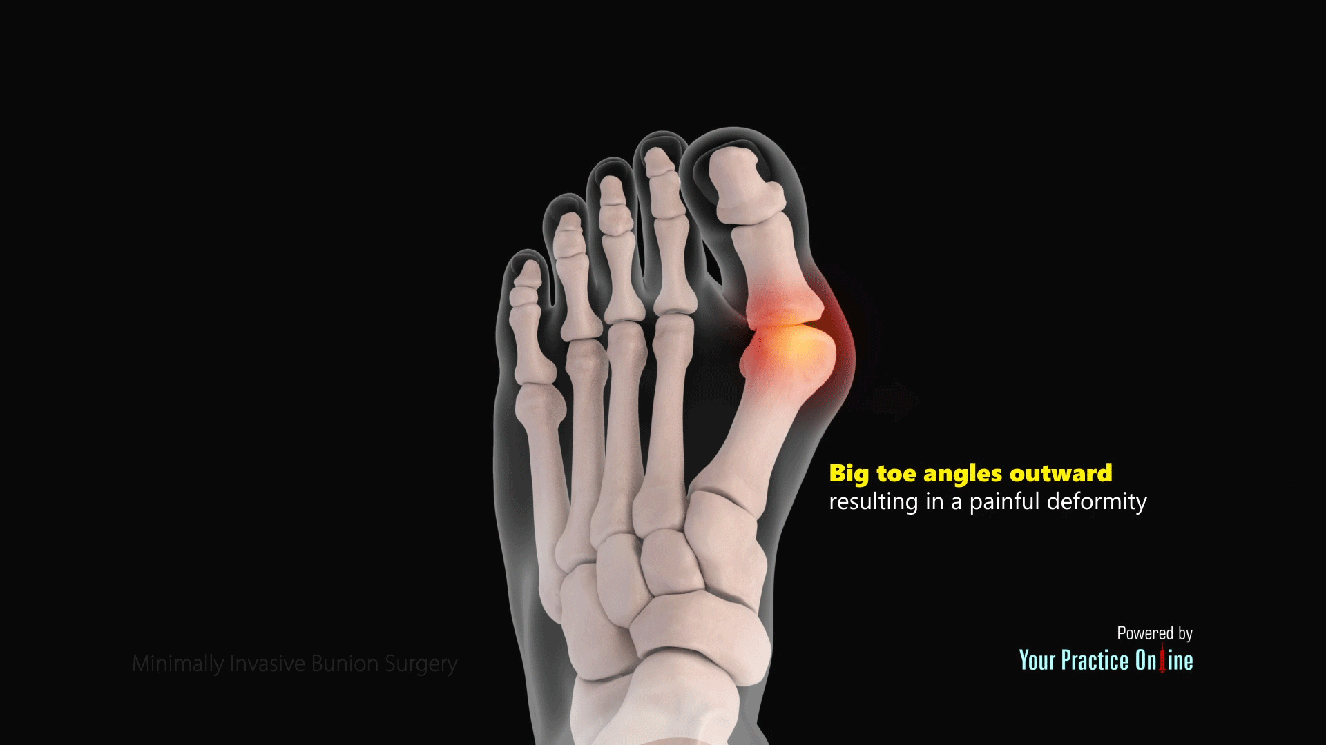 Cut Open Foot Surgery