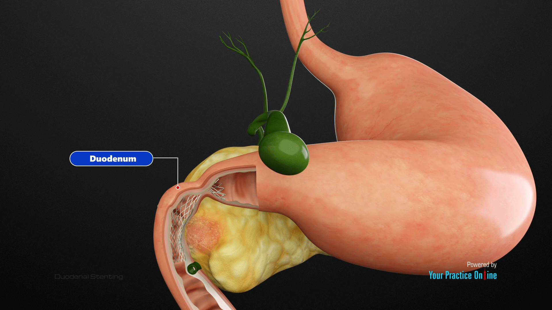 Duodenal Stenting Video | Medical Video Library
