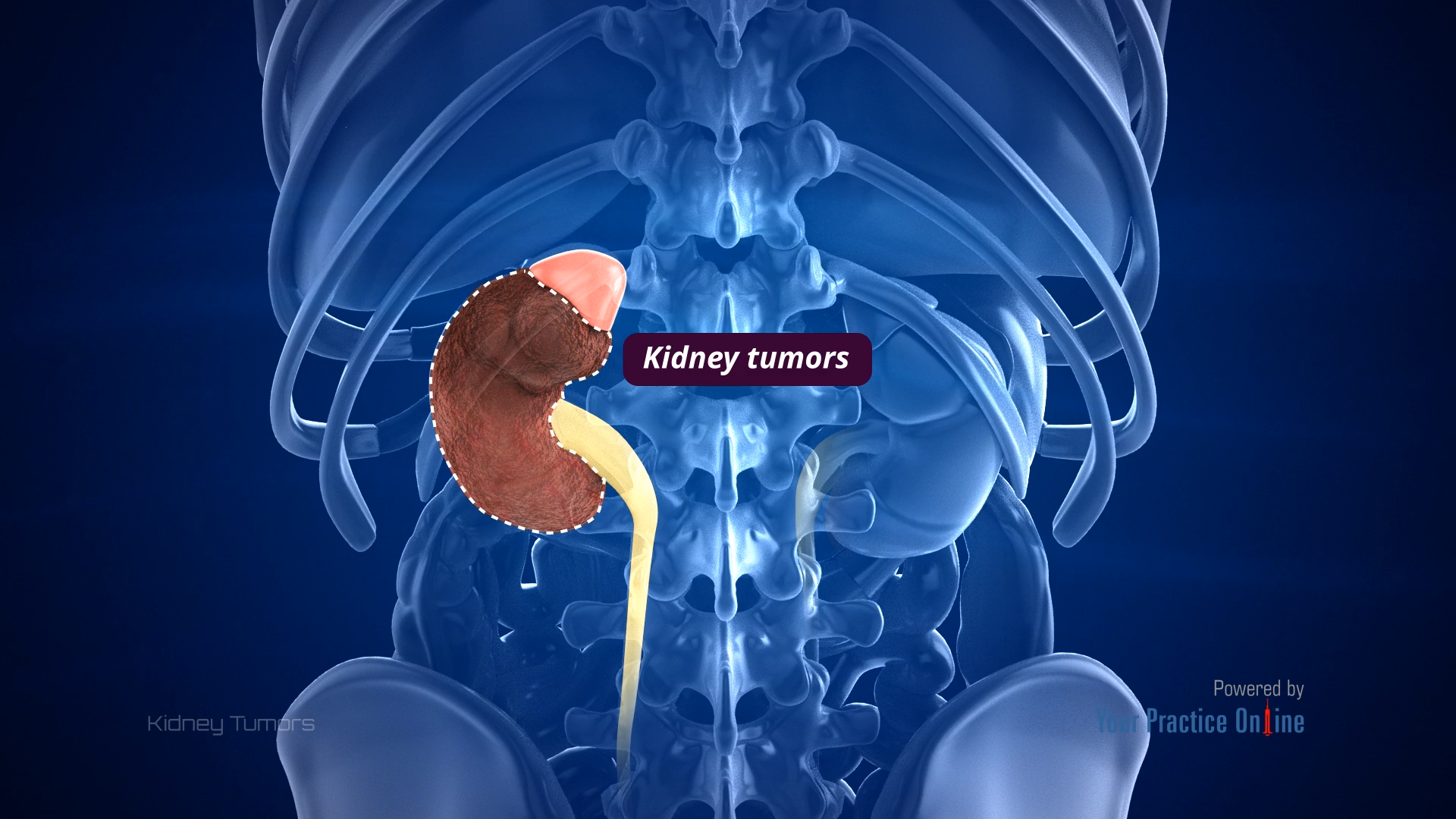 Kidney Tumors Video | Medical Video Library