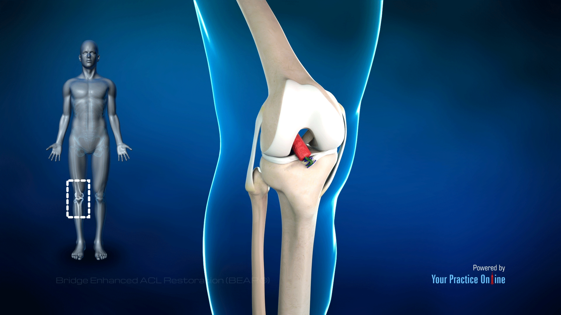 Bridge Enhanced ACL Restoration (BEAR) Video | Medical Video Library