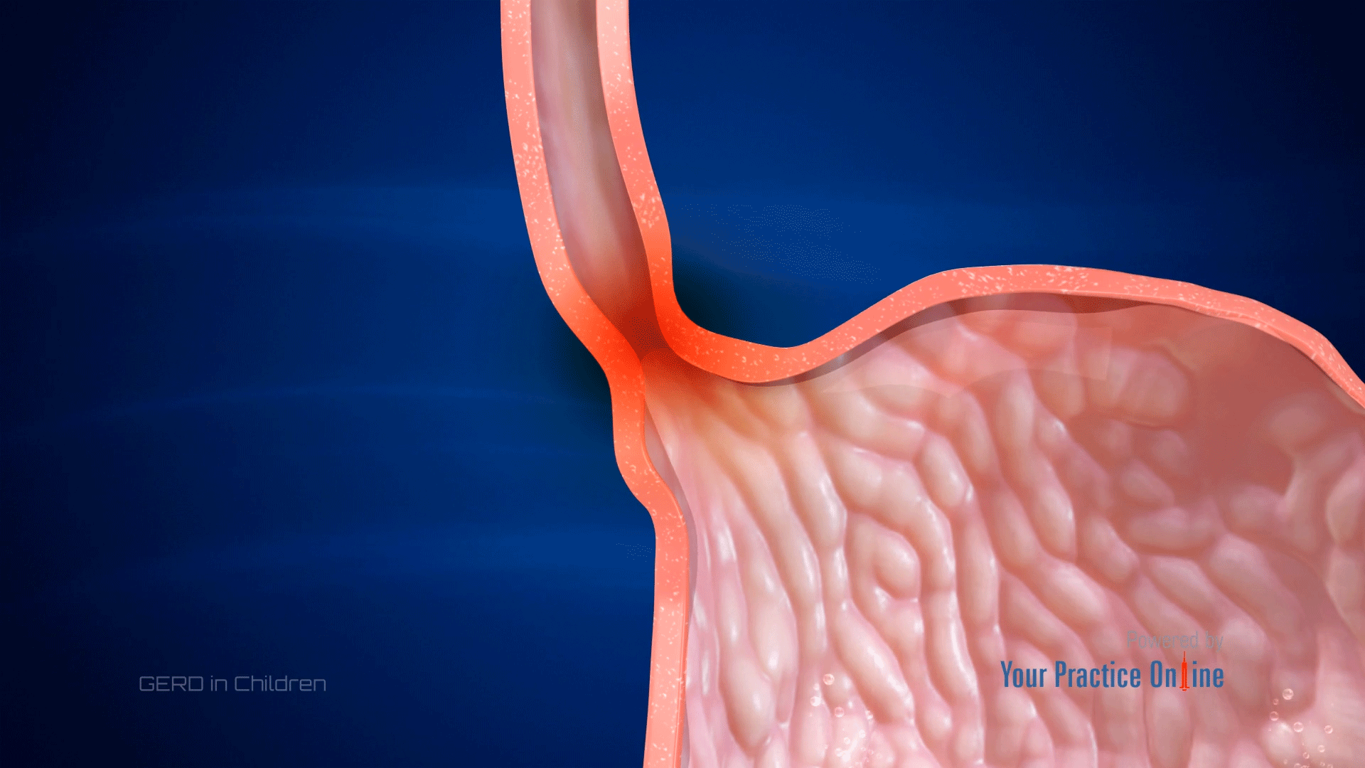 GERD in Children Video | Medical Video Library