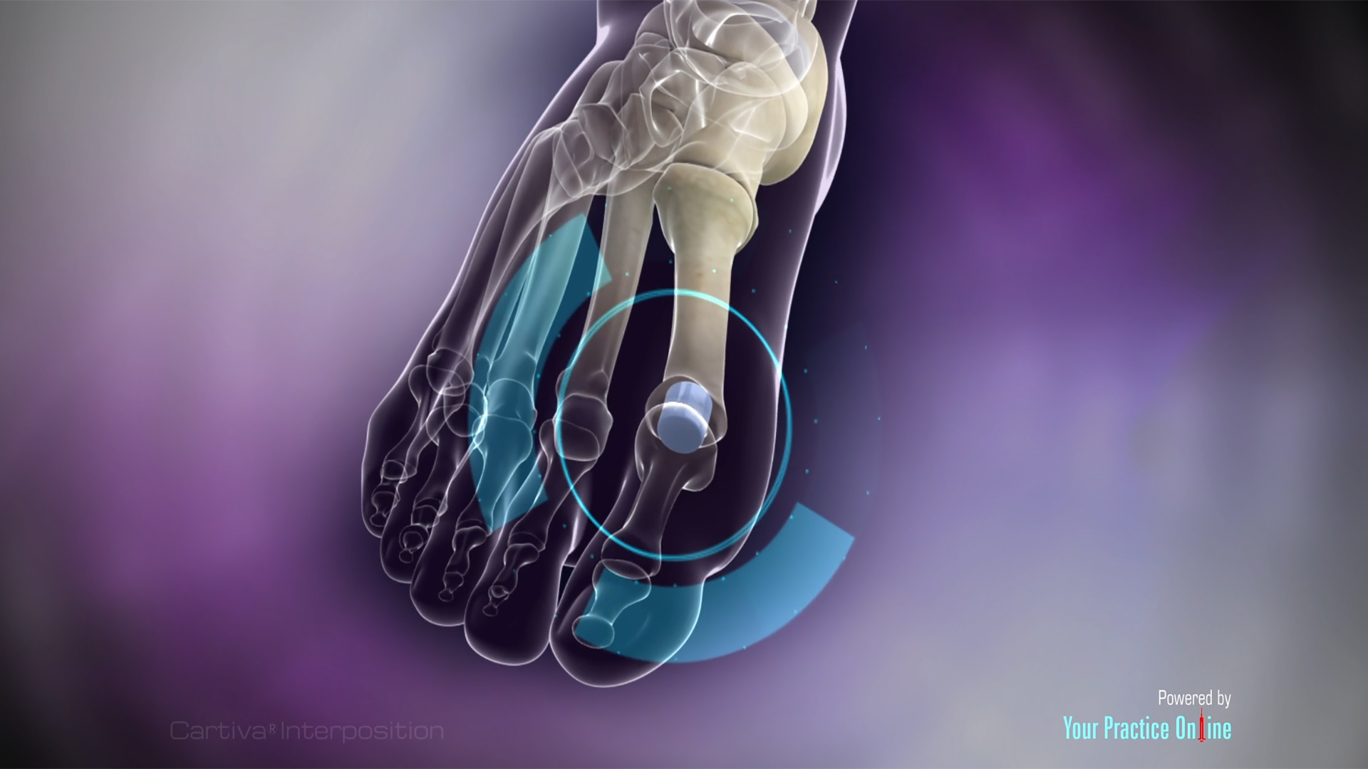 Cartiva® Interposition Arthroplasty Video | Medical Video Library