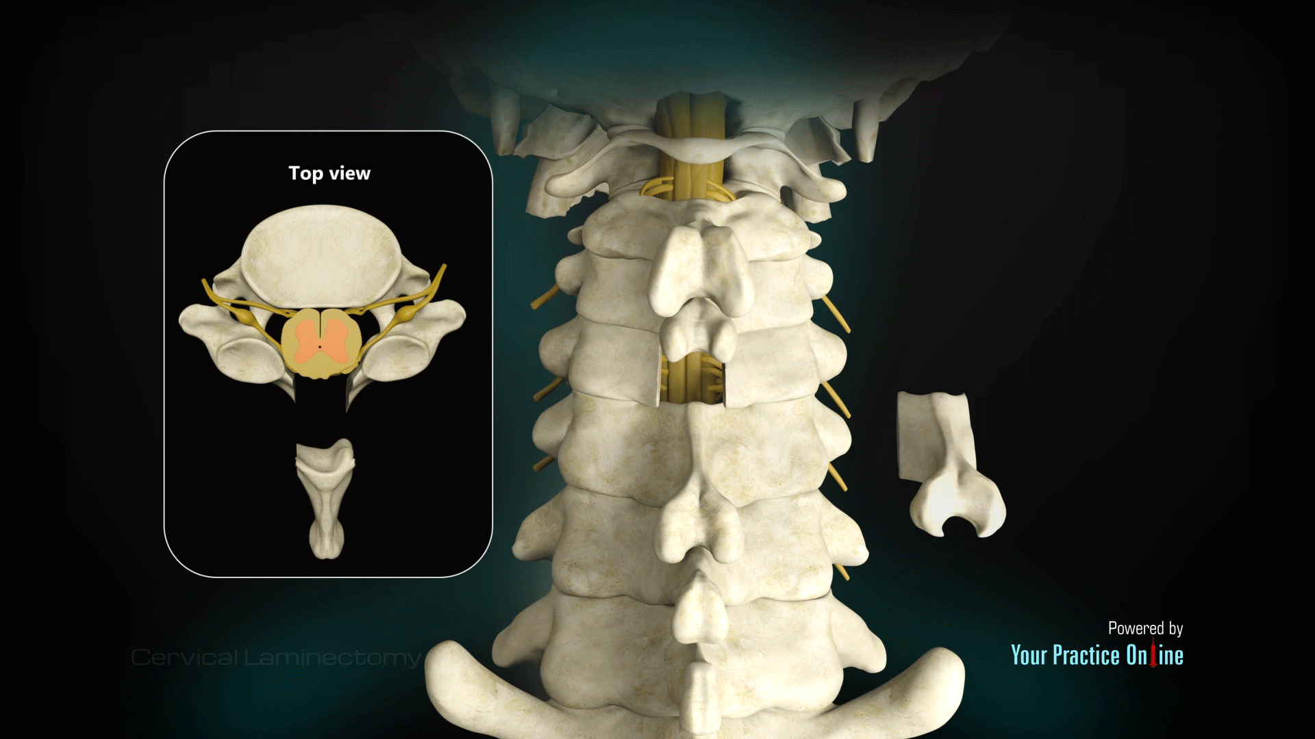Cervical Laminectomy Without Fusion Video Medical Video Library