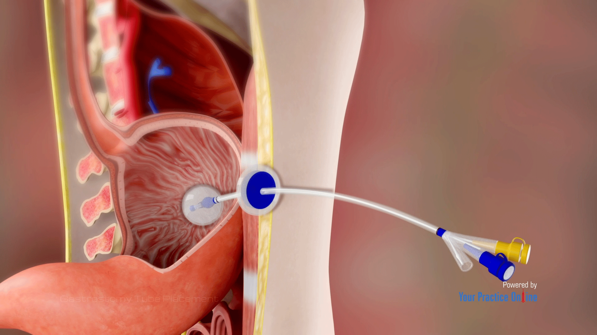 Gastrostomy Tube Placement Video Medical Video Library