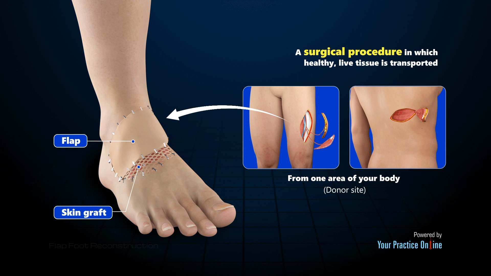 FLAP Foot Reconstruction Video | Medical Video Library