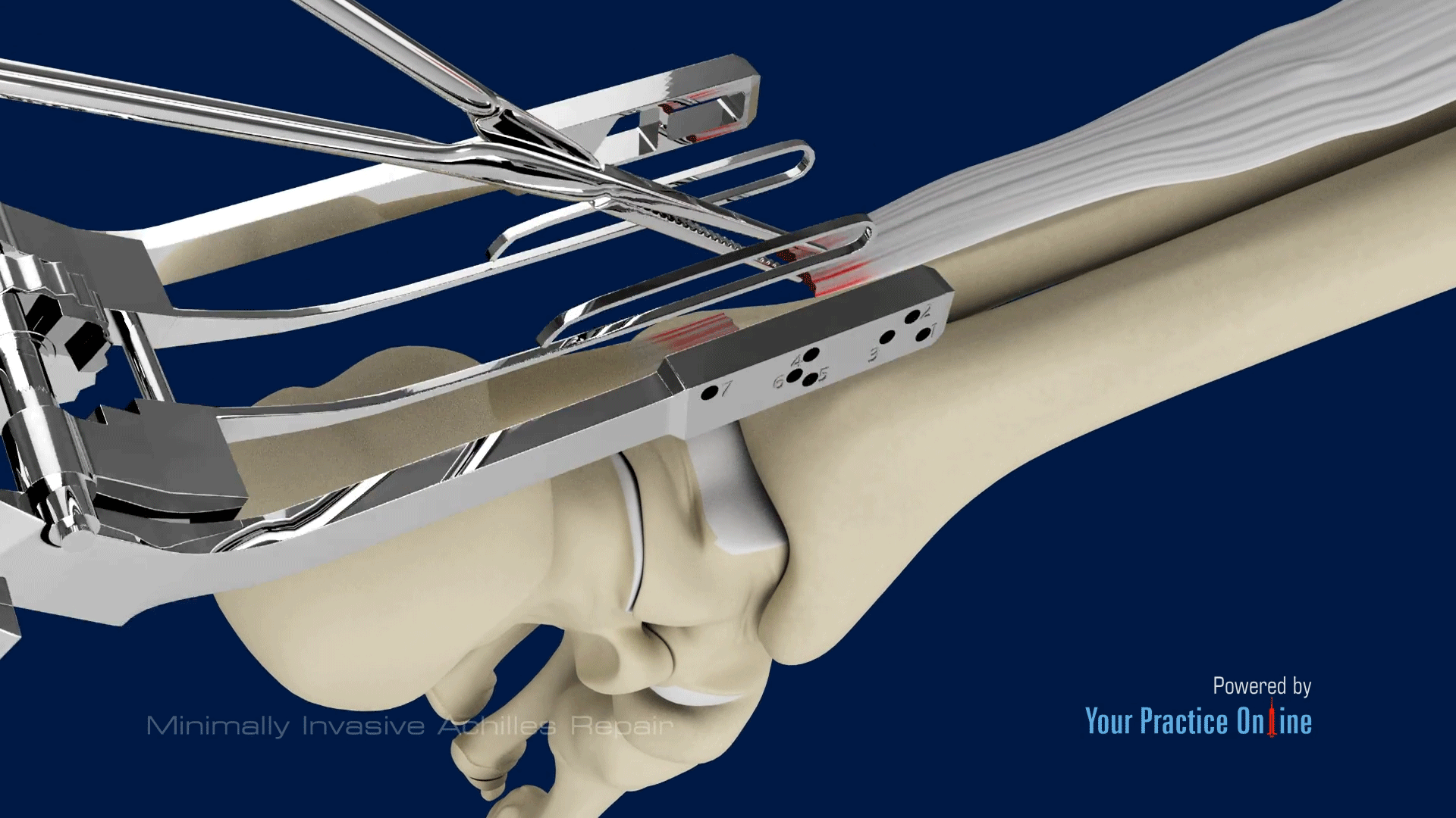 Minimally Invasive Achilles Repair Video | Medical Video Library