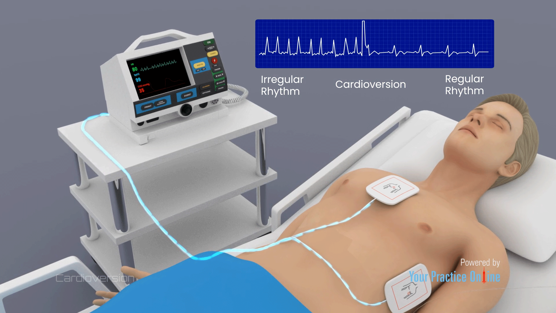 Cardioversion Video | Medical Video Library