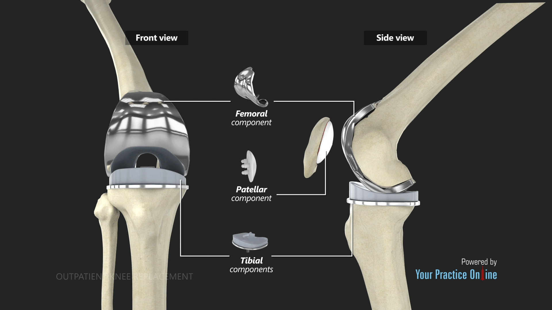 Outpatient Knee Replacement Video | Medical Video Library