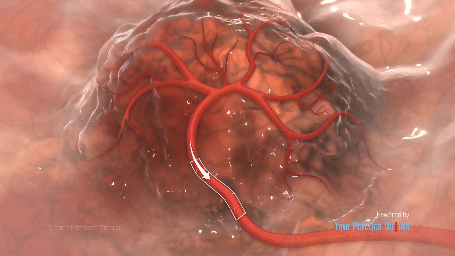 Tumor Marker Tests Video | Medical Video Library Tumor Marker Tests Video | Medical Video Library