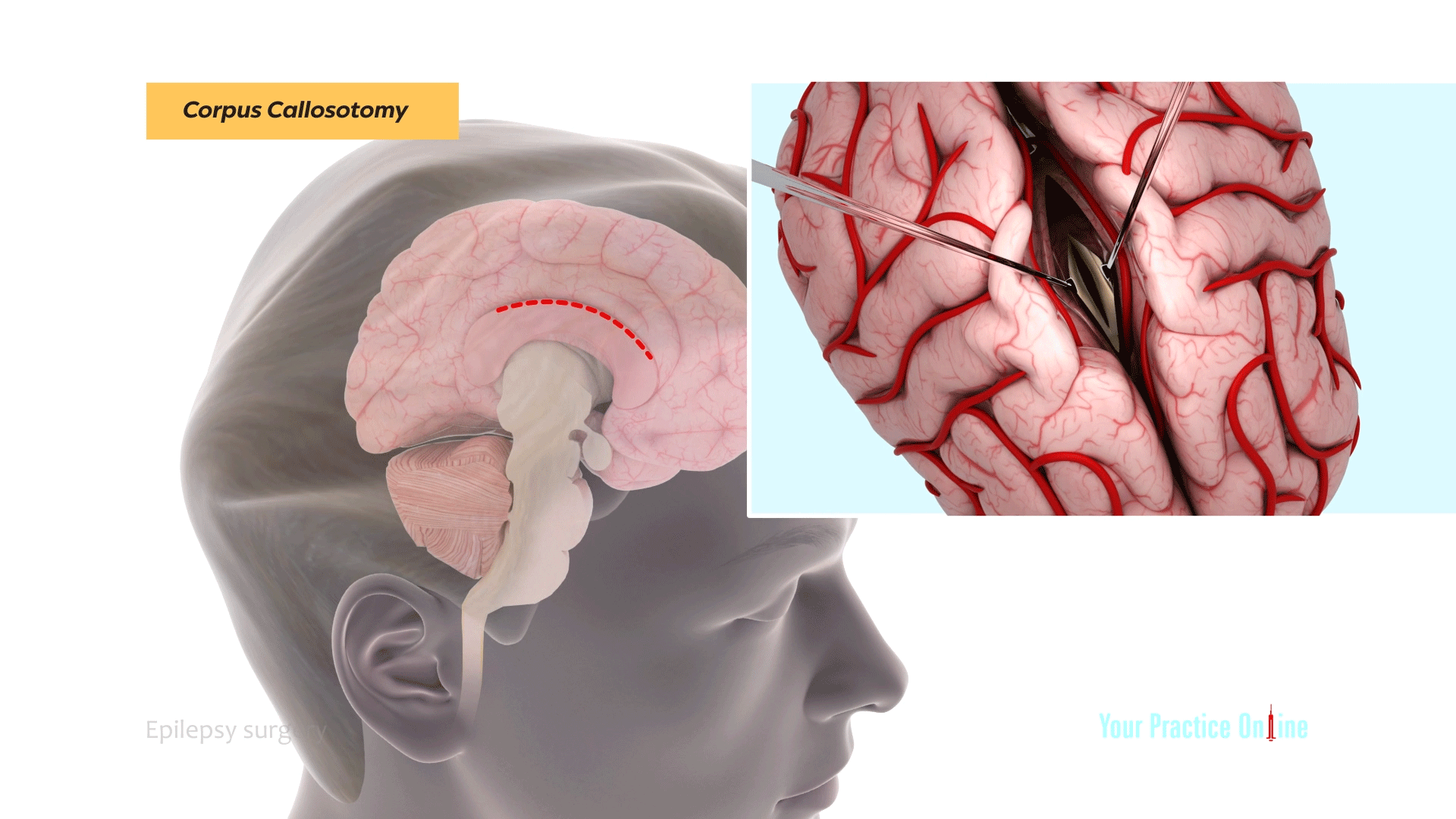 Epilepsy Surgery Video | Medical Video Library