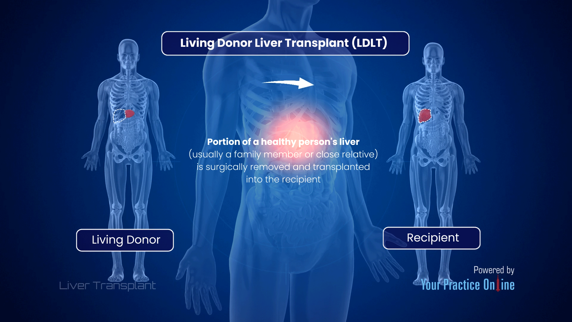 Liver Transplant Video | Medical Video Library