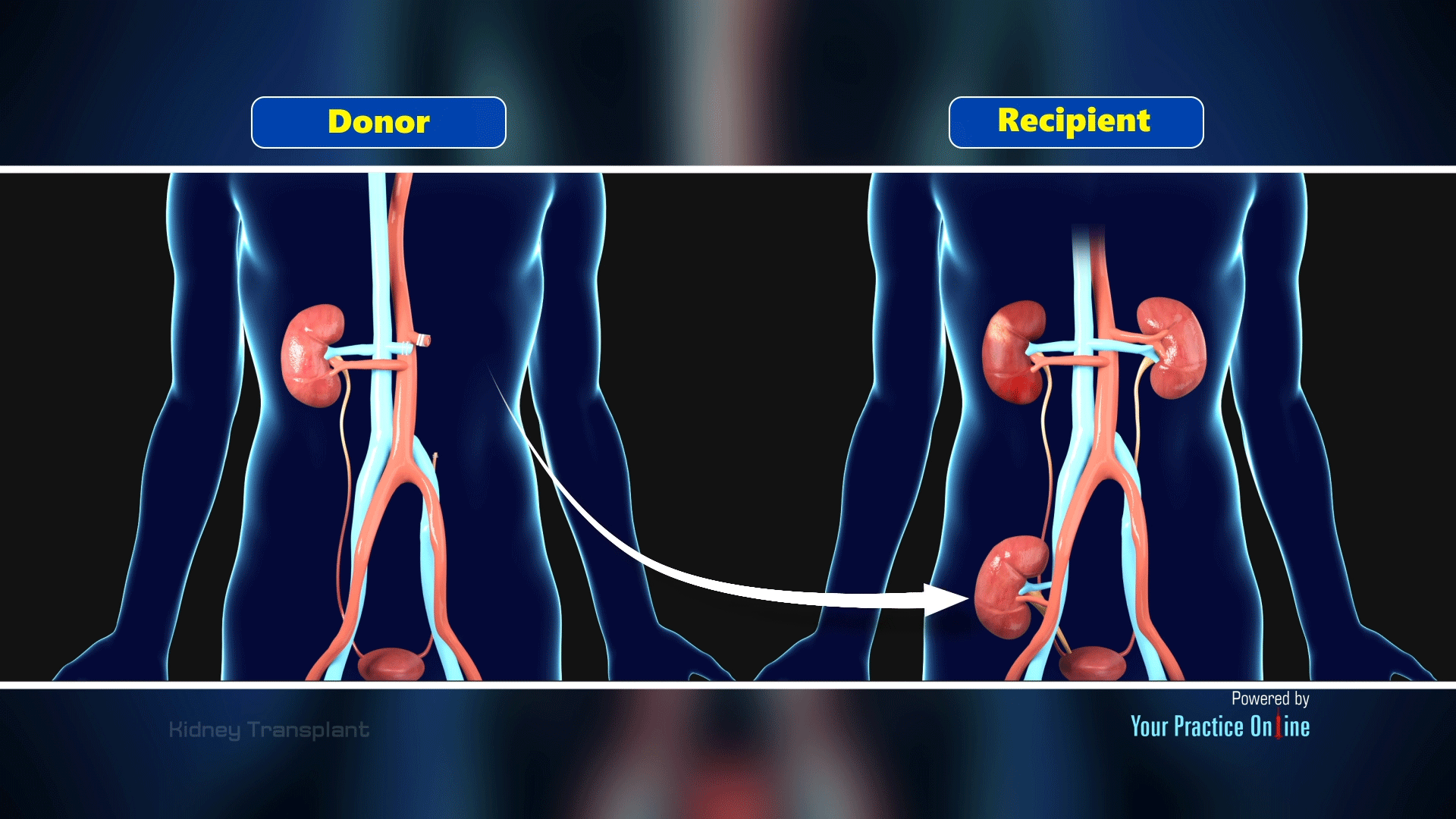 Kidney Transplant Video | Medical Video Library