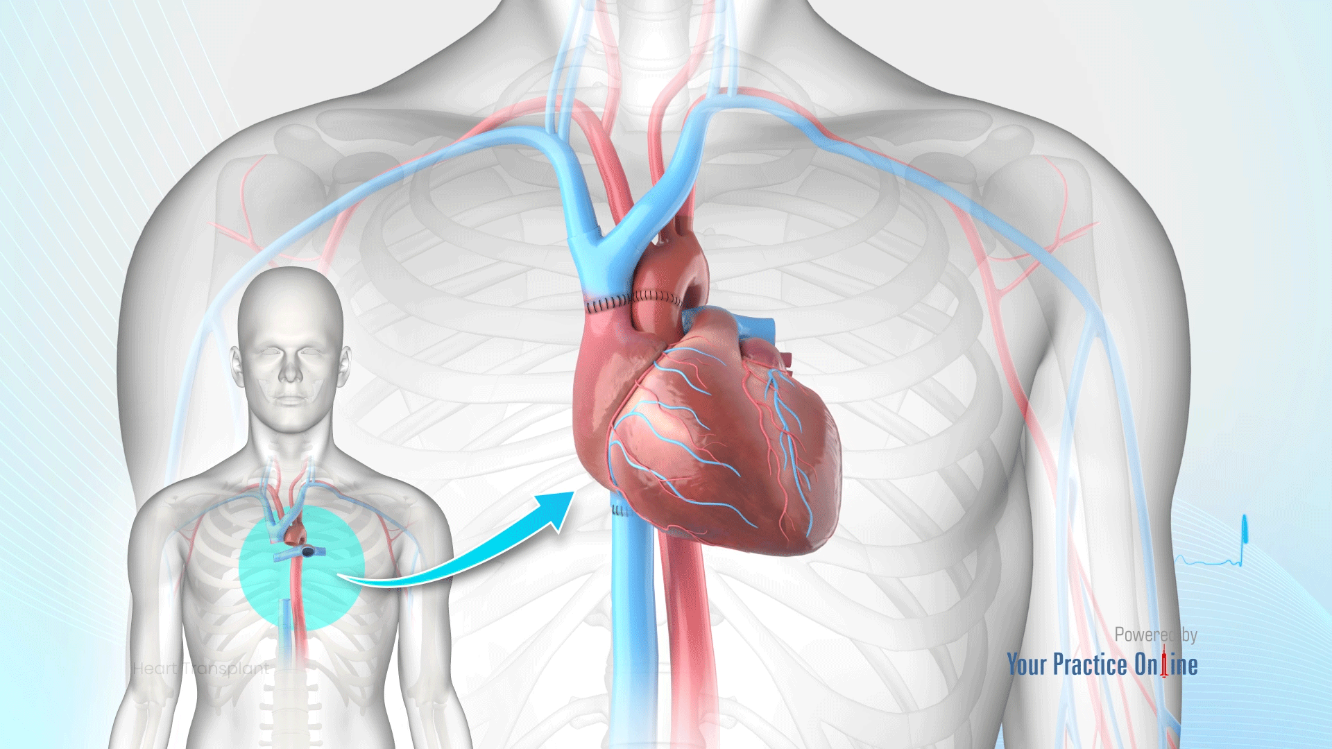 Heart Transplant Video | Medical Video Library