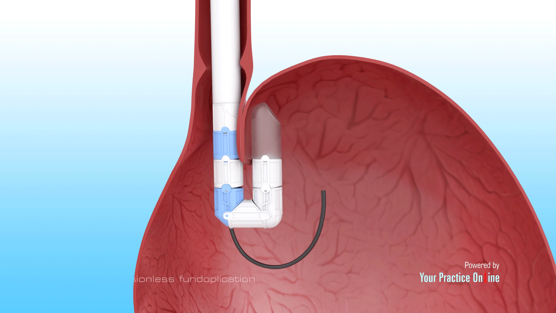 Transoral Incisionless Fundoplication (TIF) Video | Medical Video Library