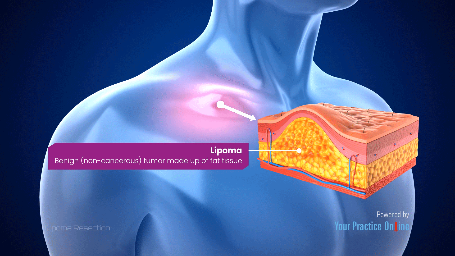 Lipoma Resection Video | Medical Video Library
