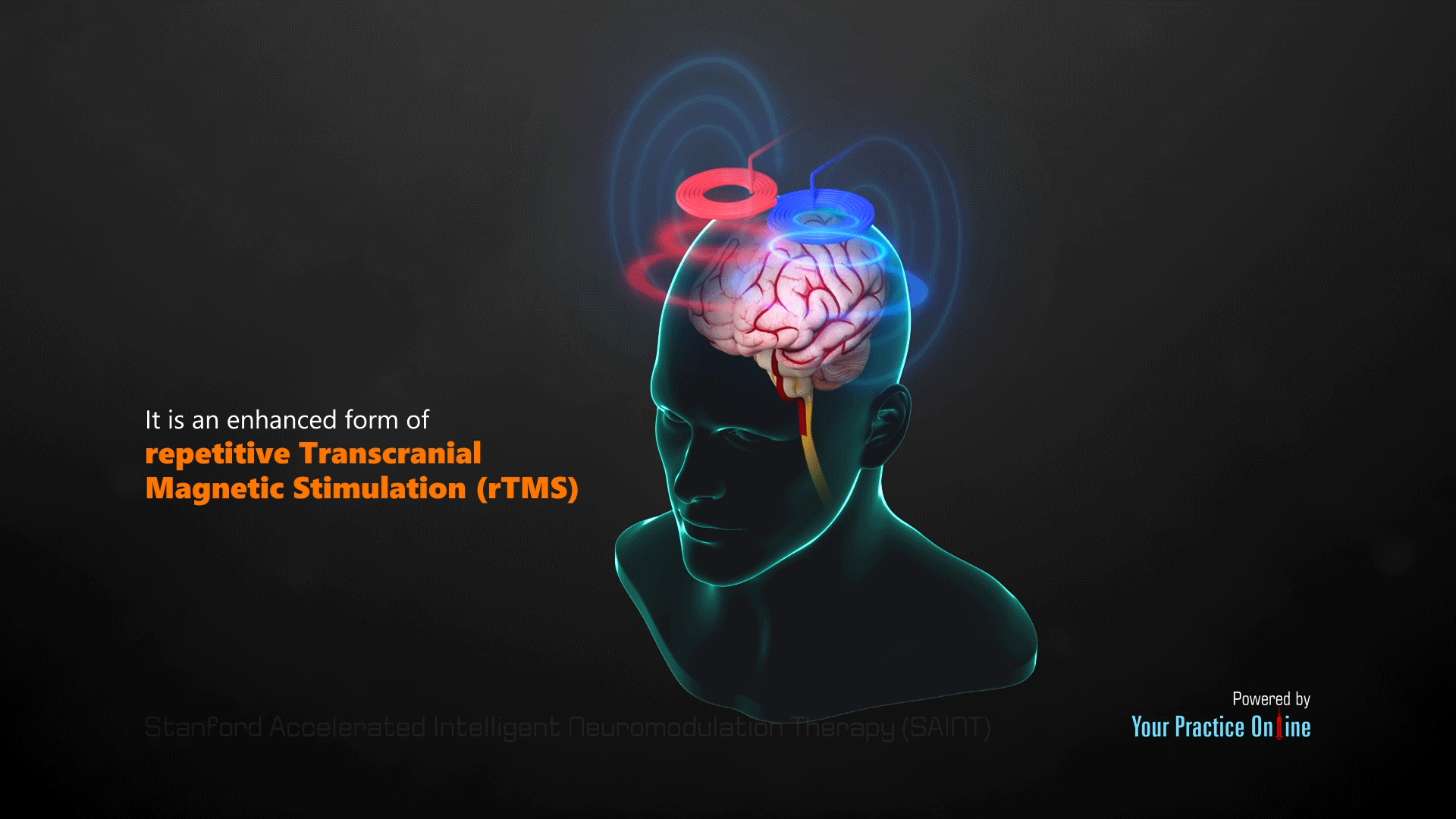 Stanford Accelerated Intelligent Neuromodulation Therapy (SAINT) Video ...