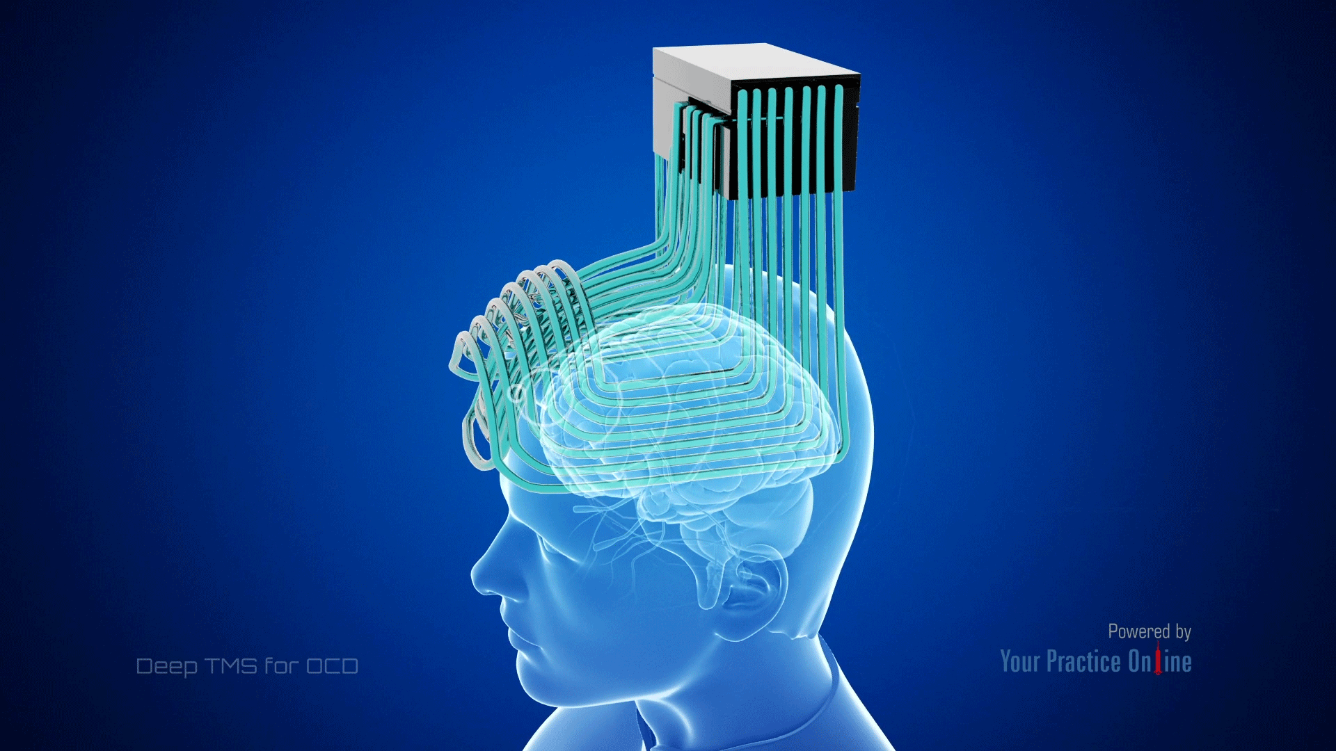 Deep TMS for OCD Video | Medical Video Library
