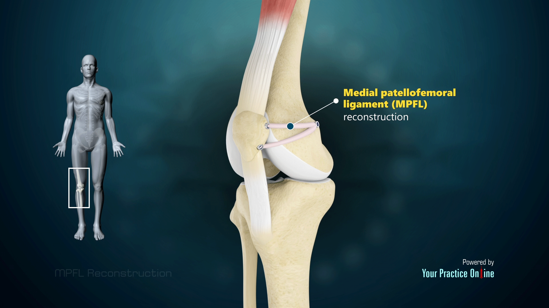 Medial Patellofemoral Ligament (MPFL) Reconstruction Video | Medical Video Library