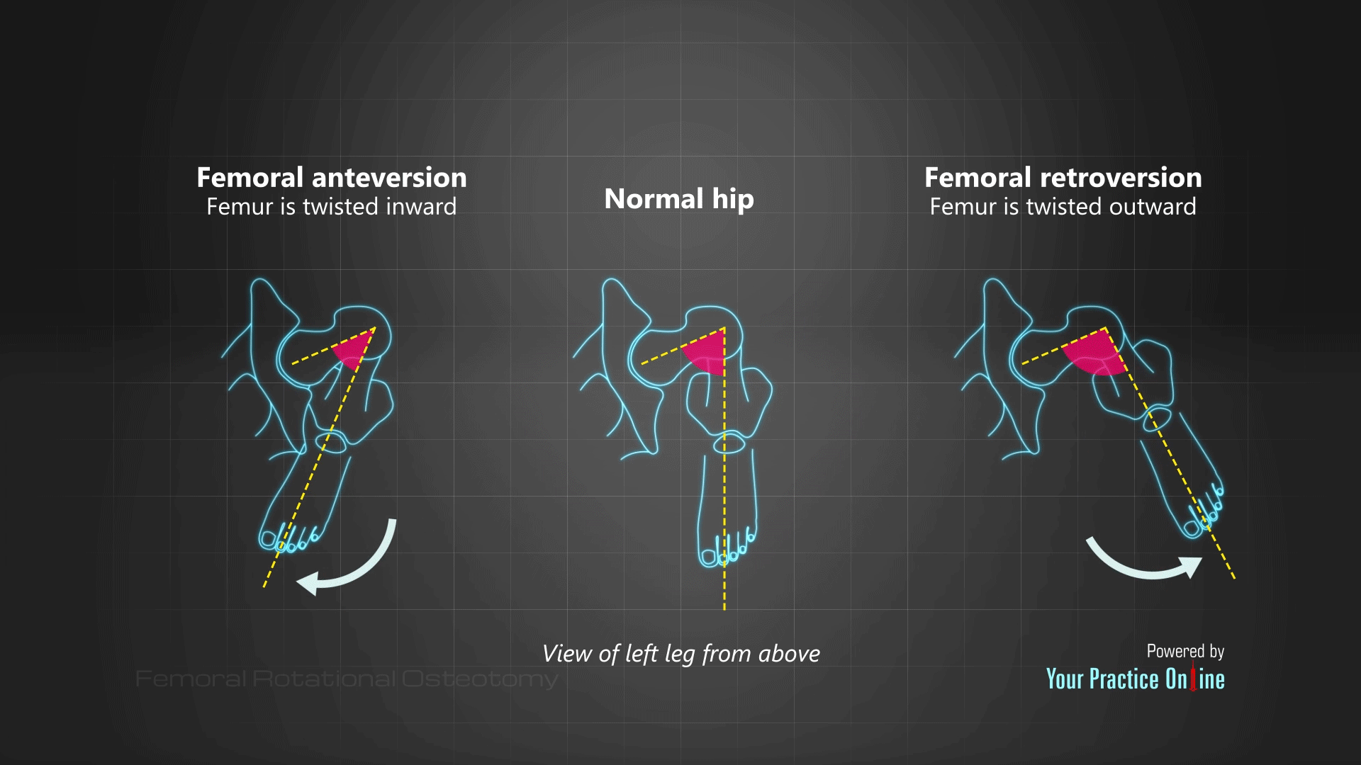 Femoral Rotational Osteotomy Video | Medical Video Library