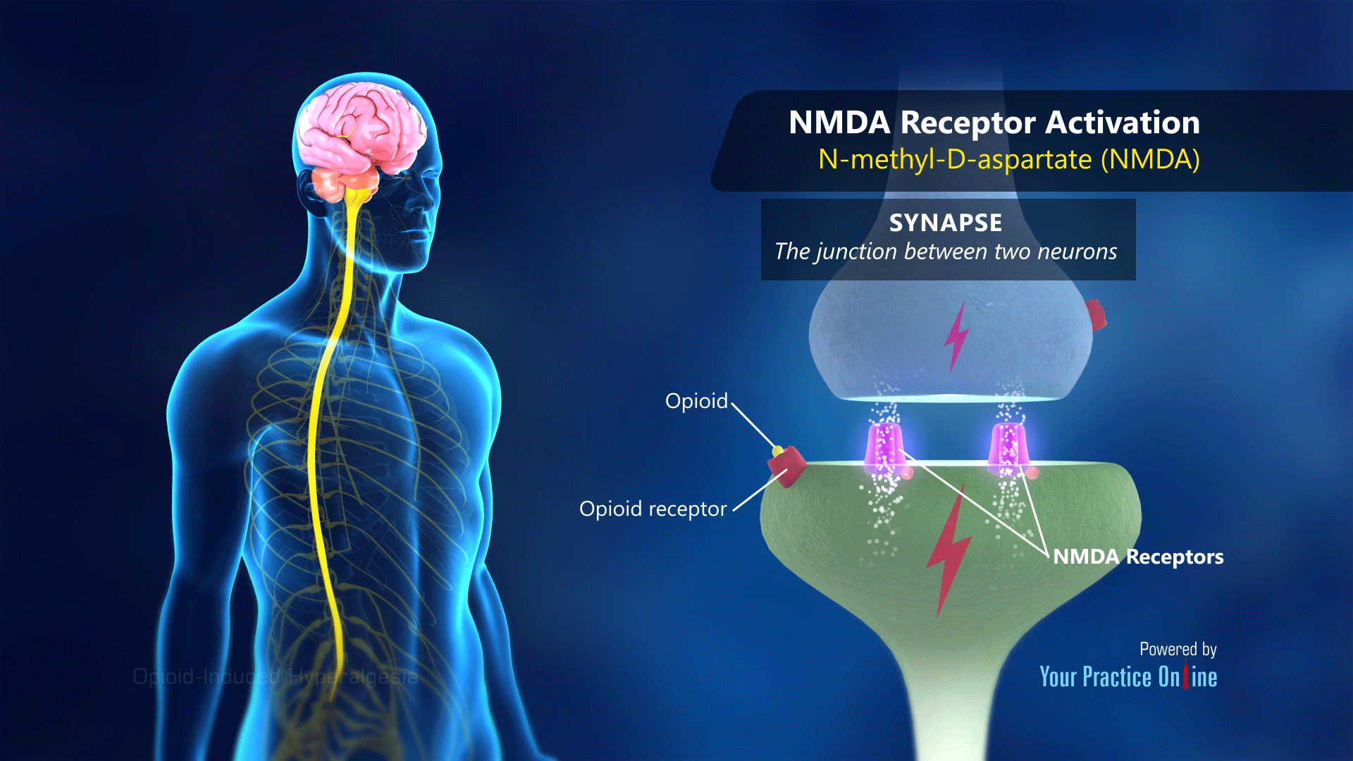 Opioid Induced Hyperalgesia Video | Medical Video Library