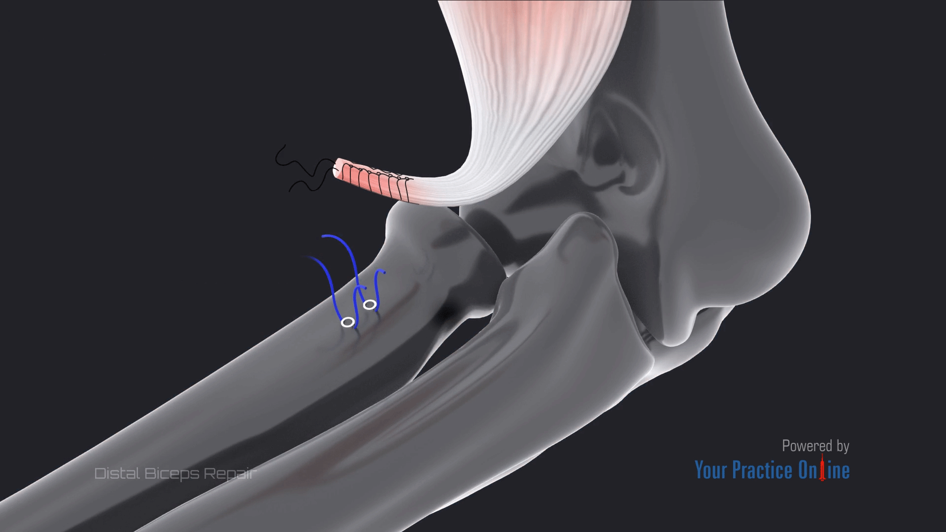 Distal Biceps Repair Video | Medical Video Library