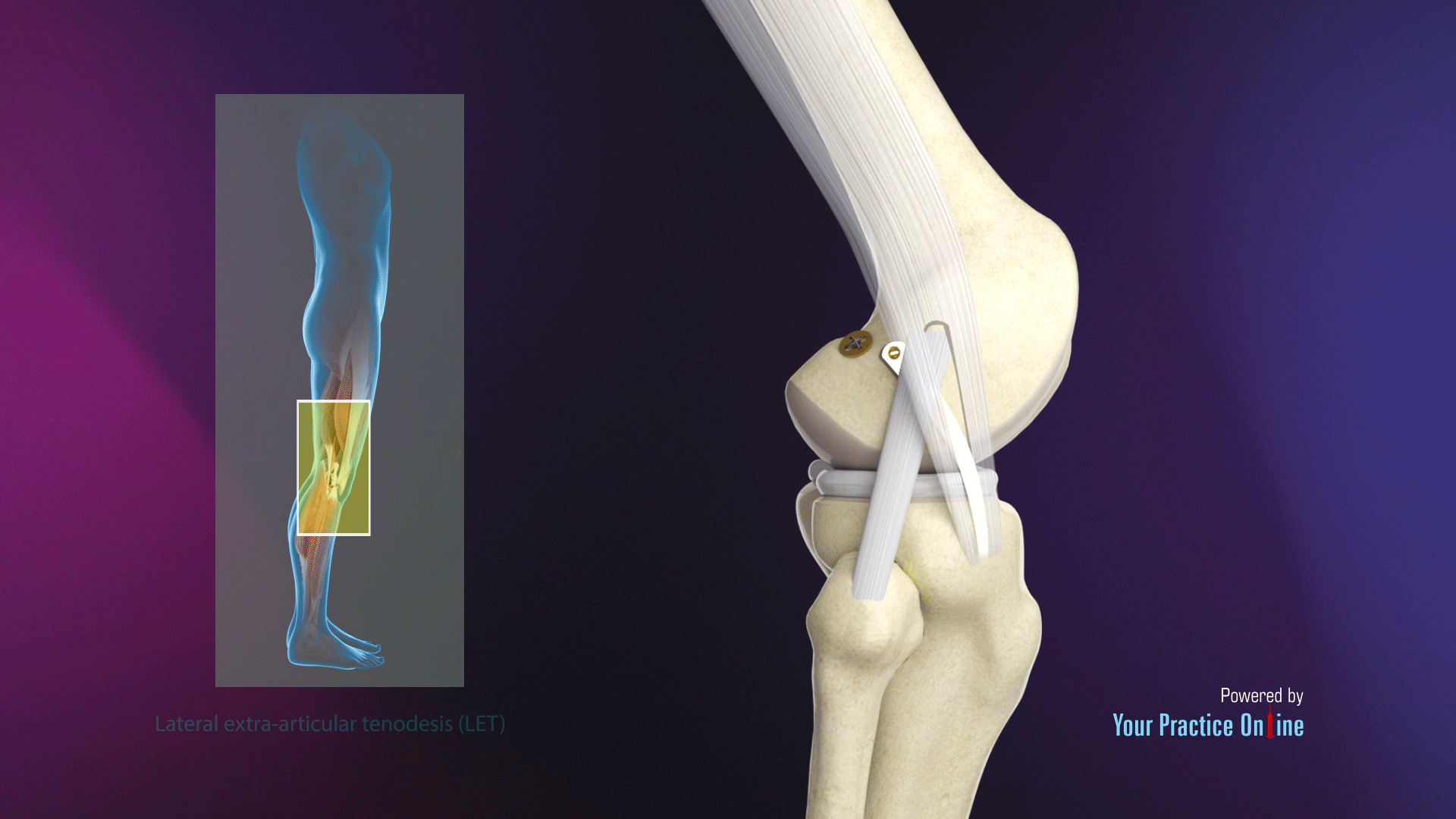LET - Lateral Extra-Articular Tenodesis Video | Medical Video Library