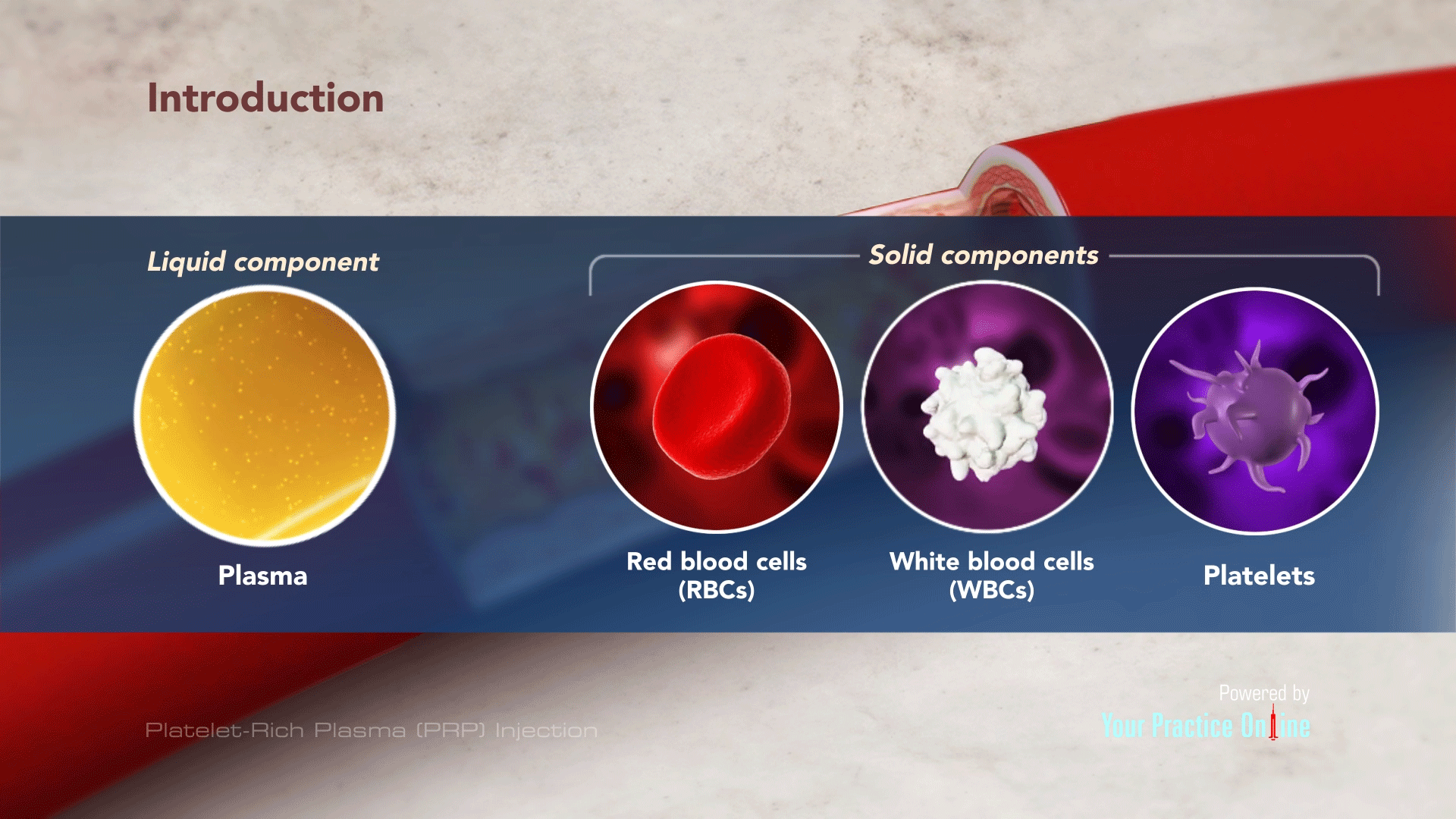 Platelet Rich Plasma Injection (PRP) Video | Medical Video Library