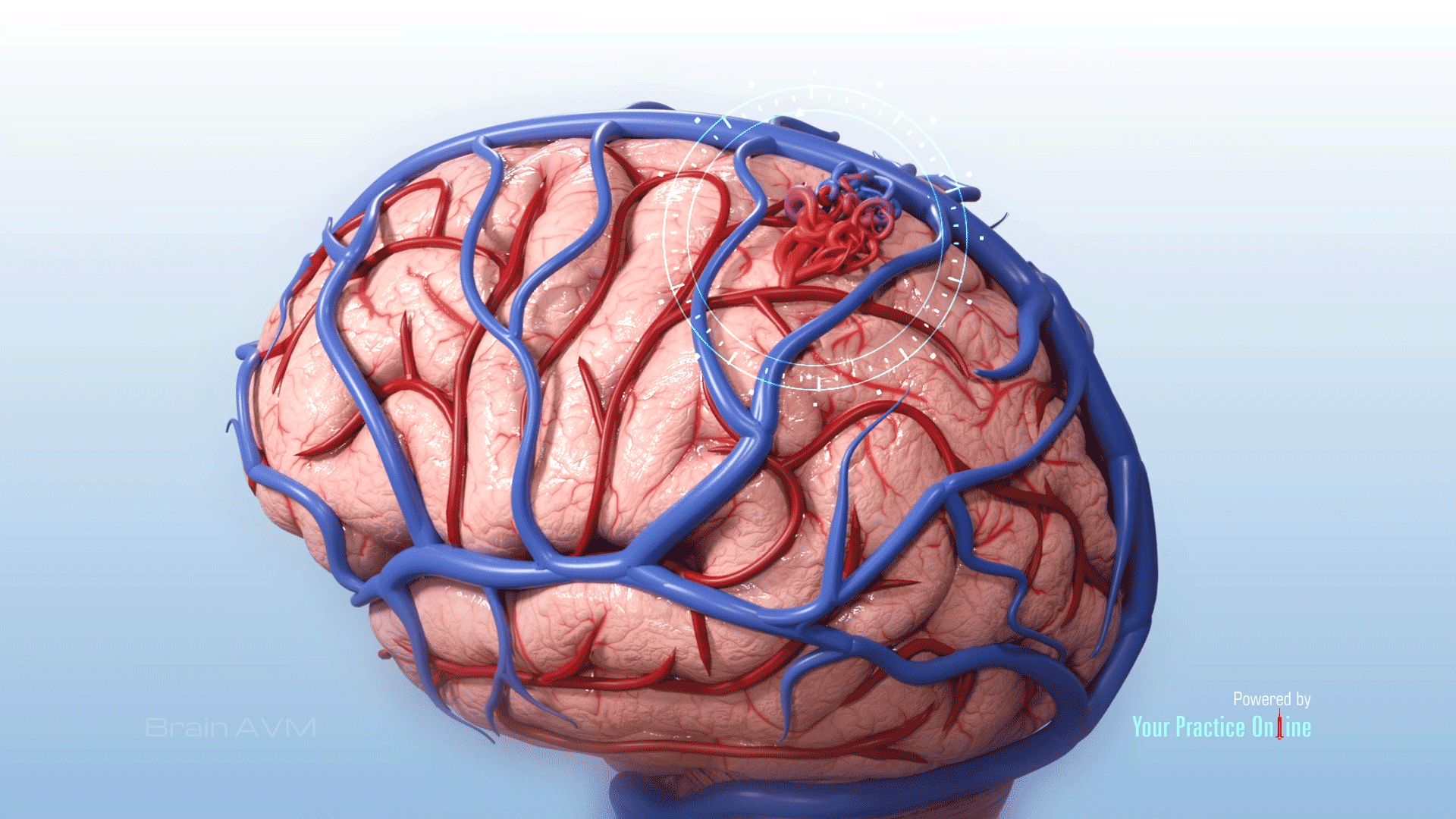Brain AVM Video | Medical Video Library