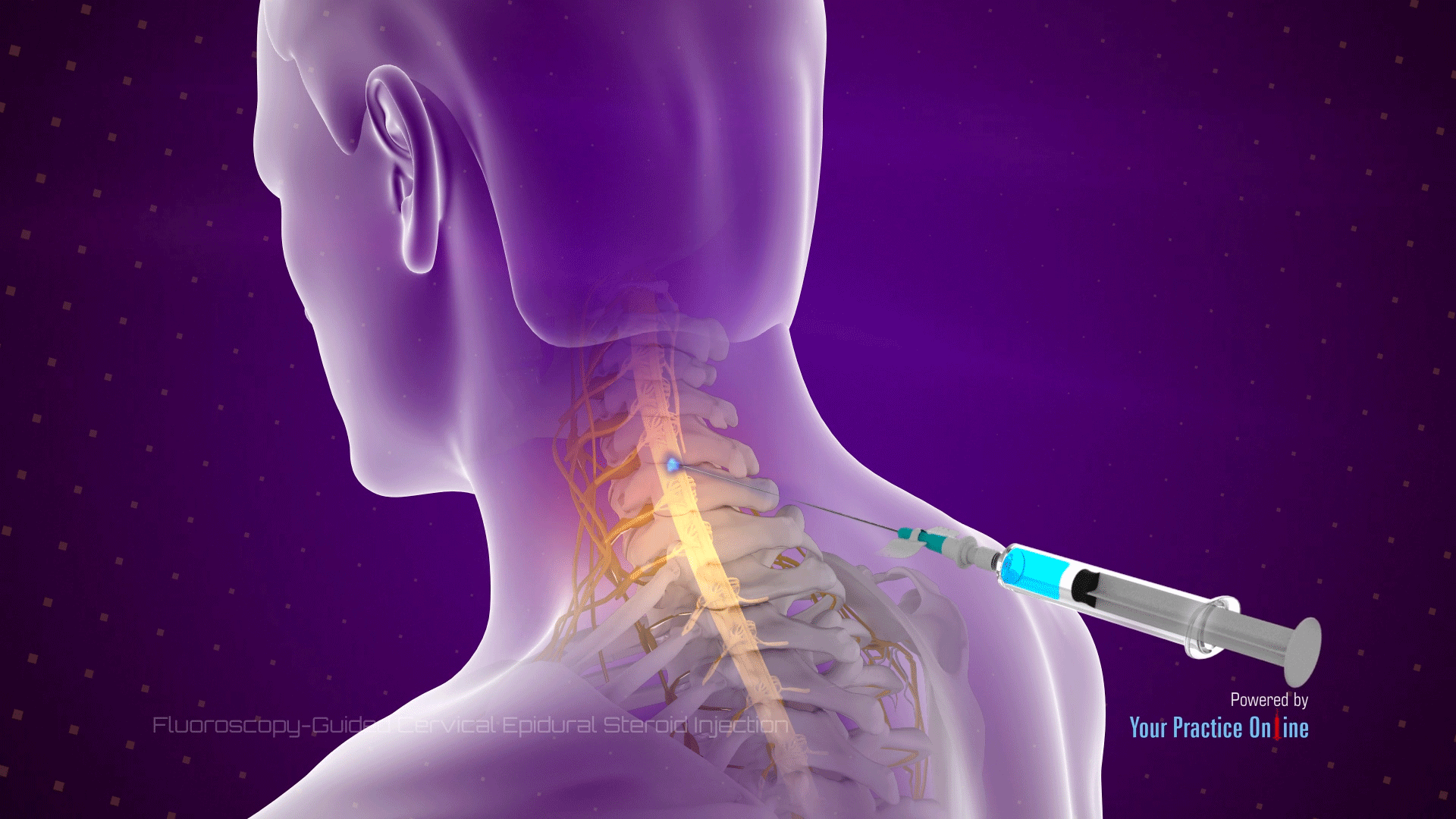 Fluoroscopy-Guided Cervical Epidural Steroid Injection Video | Medical ...