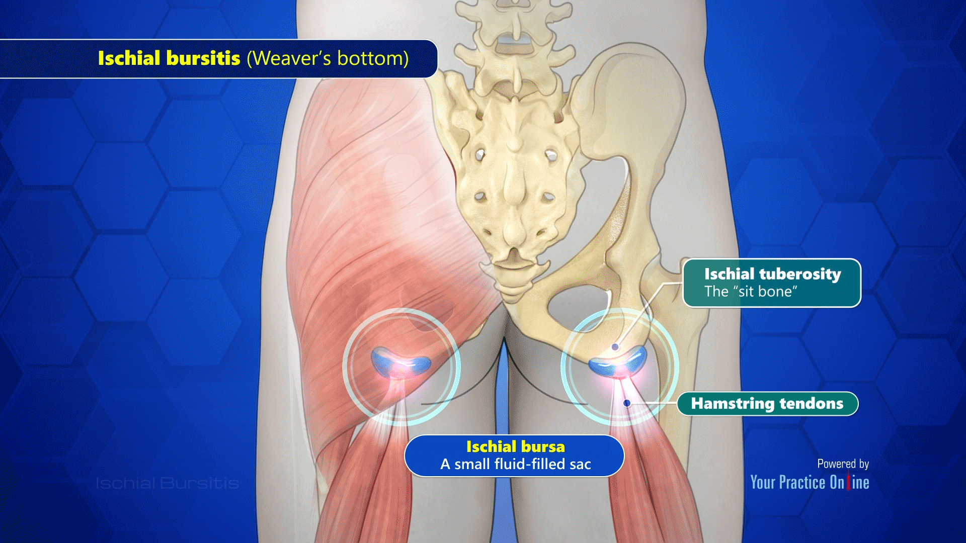 Ischial Bursitis Video | Medical Video Library