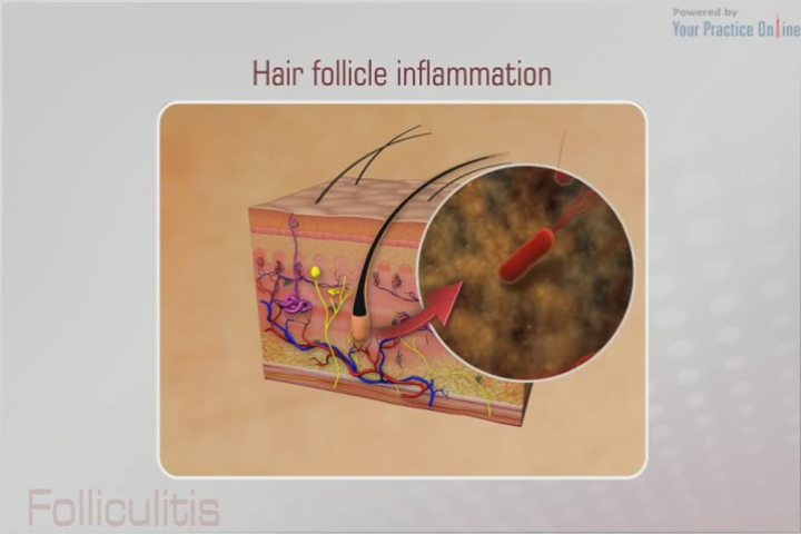 Folliculitis Treatment Video | Bacterial Infection Treatment
