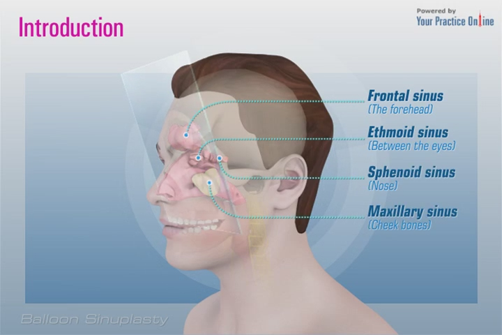Balloon Sinuplasty Video | Minimally Invasive Surgery
