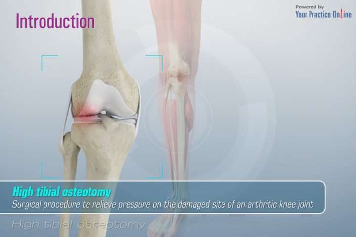 High Tibial Osteotomy | Knee Orthopaedics Videos | Your Practice Online ...