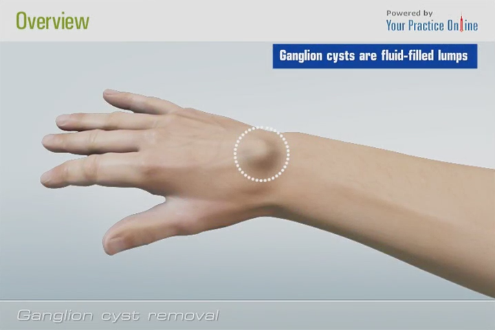 Ganglion Cyst Removal | Hand & Wrist Orthopaedics Videos | Your ...