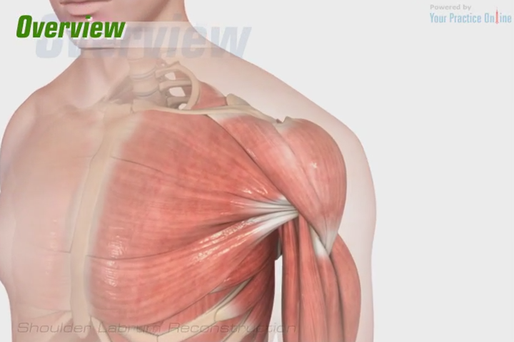 Shoulder Labrum Reconstruction Video | Medical Video Library