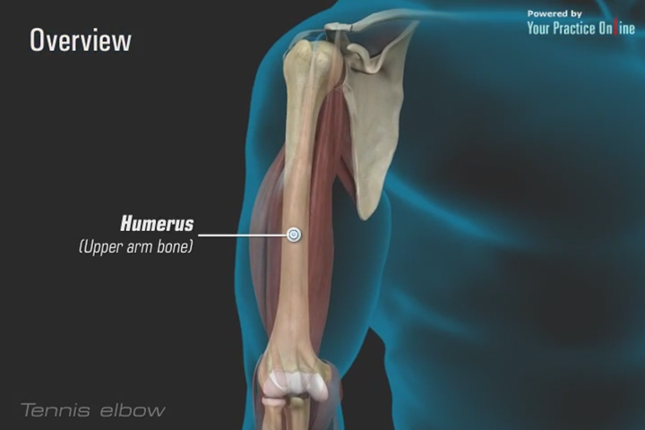 Tennis Elbow | Elbow Orthopaedics Videos | Your Practice Online Education