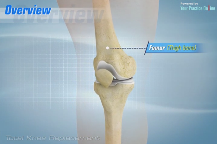 Total Knee Replacement | Knee Orthopaedics Videos | Your Practice ...